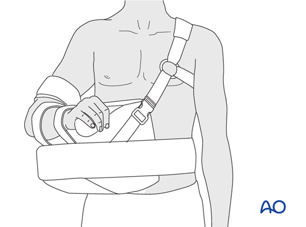 Nonoperative for Isolated anatomical neck, dislocation
