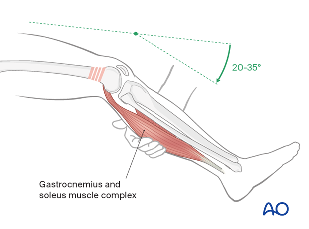 Temporary long leg splint for Partial articular fracture, medial ...