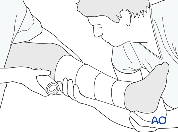 Temporary long leg splint for Partial articular fracture, medial ...