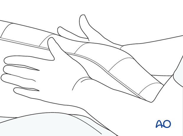 Temporary long leg splint for Partial articular fracture, medial ...