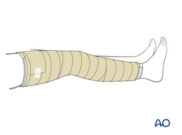 Temporary long leg splint for Partial articular fracture, medial ...