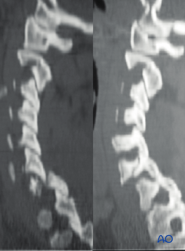 A4 Burst fracture or sagittal split involving both endplates for Burst ...