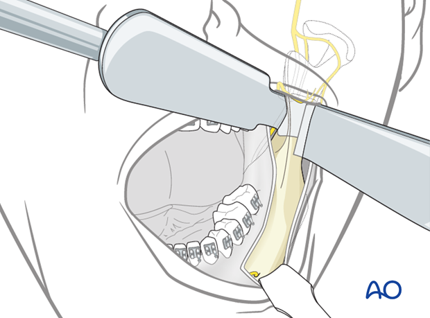 BSSO (Obwegeser) for Mandibular retrognathism