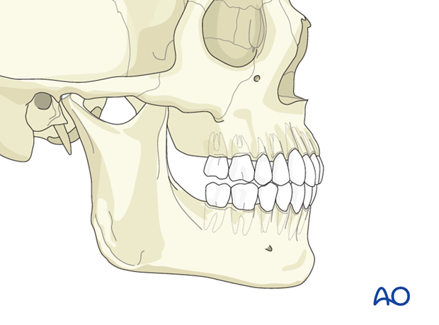 Vertical mandibular hyperplasia