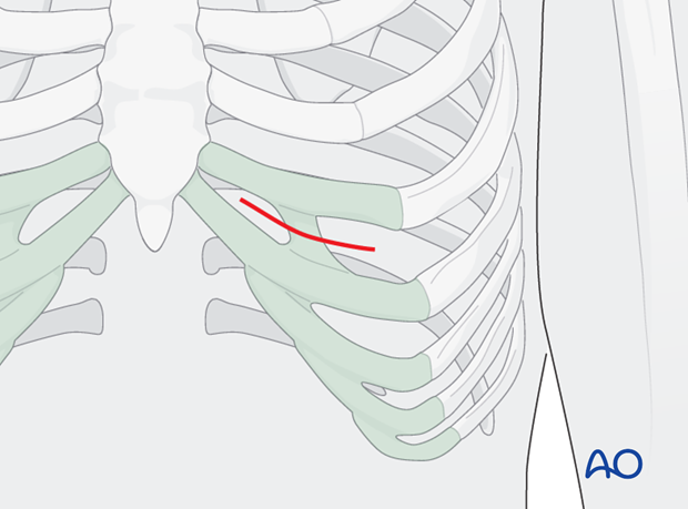 Construction of mandibular ramus and condyle for Pruzansky IIb