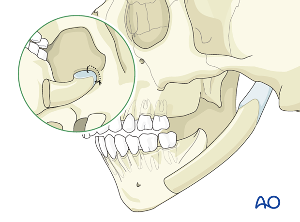 Construction of mandibular ramus and condyle for Pruzansky IIb