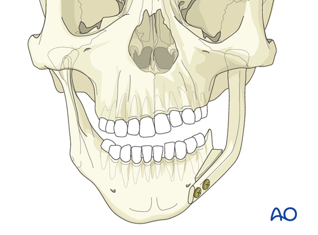 Construction of mandibular ramus and condyle for Pruzansky IIb