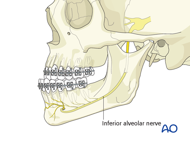 BSSO (Obwegeser) for Mandibular retrognathism