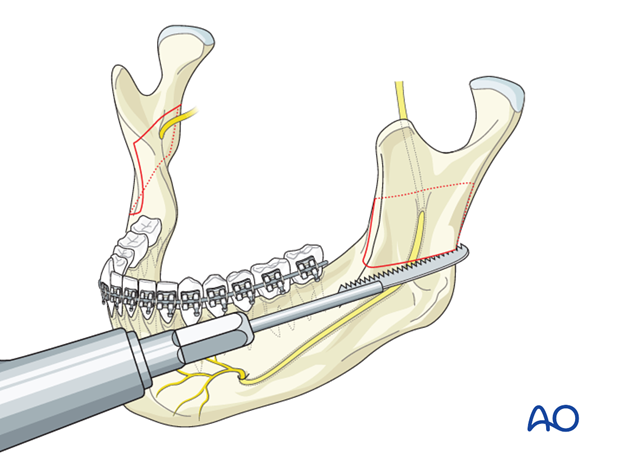 BSSO (Obwegeser) for Mandibular retrognathism