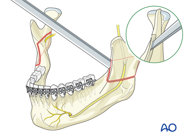BSSO (Obwegeser) for Mandibular retrognathism
