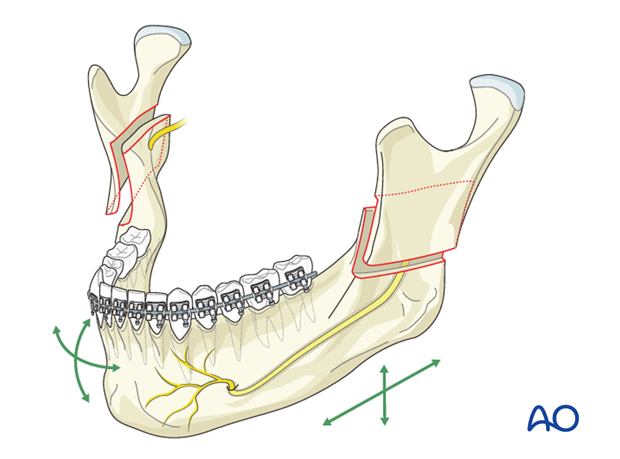 BSSO (Obwegeser) for Mandibular retrognathism
