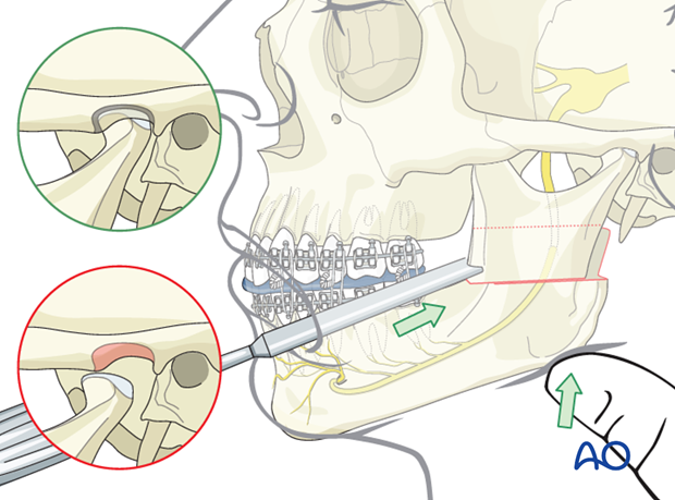 BSSO (Obwegeser) for Mandibular retrognathism