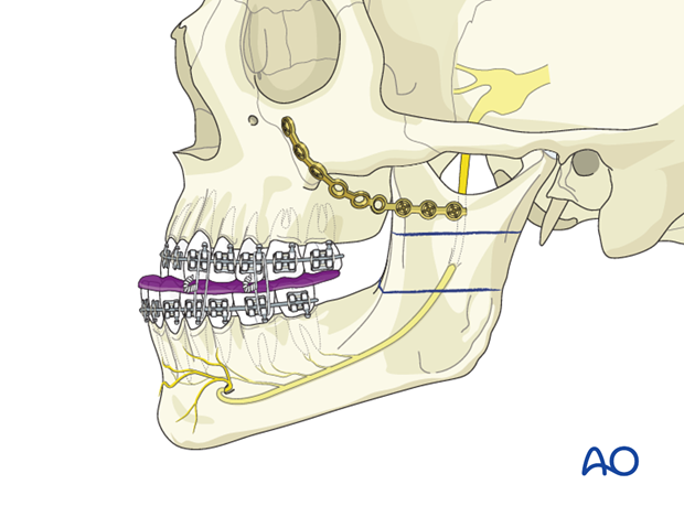 BSSO (Obwegeser) for Mandibular retrognathism