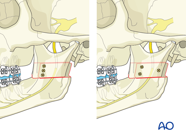 BSSO (Obwegeser) for Mandibular retrognathism