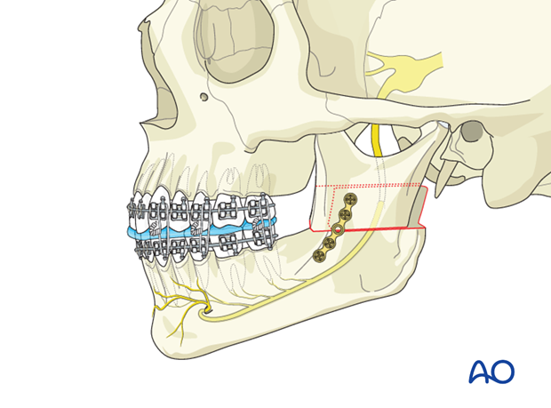 BSSO (Obwegeser) for Mandibular retrognathism