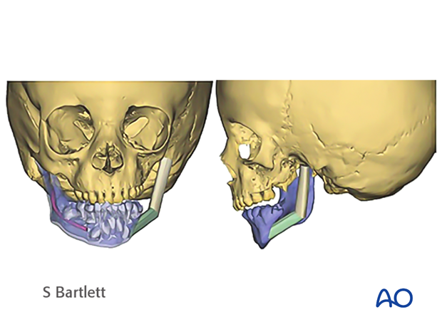 Construction of mandibular ramus and condyle for Pruzansky IIb