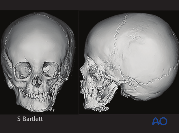 Construction of mandibular ramus and condyle for Pruzansky IIb