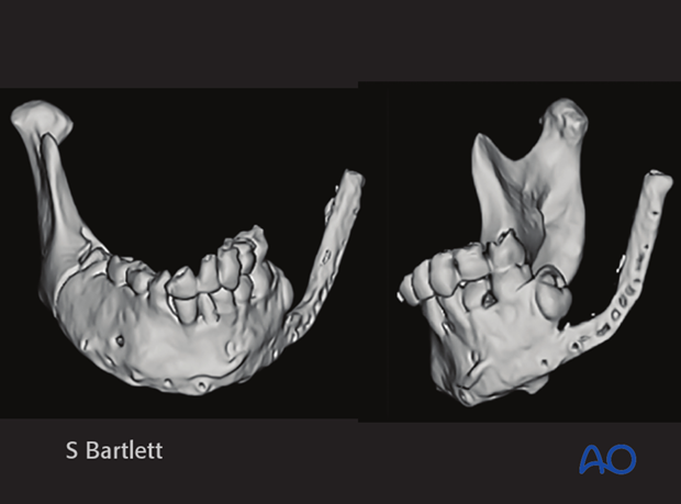 Construction of mandibular ramus and condyle for Pruzansky IIb