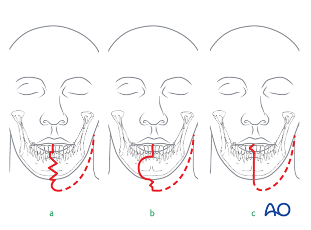 Plate and scapular osteocutaneous free flap for Symphysis and skin