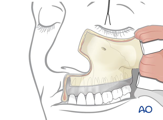 Rectus abdominis fasciocutaneous free flap for Brown III