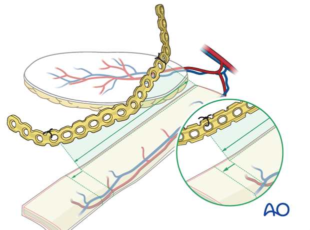 Plate and scapular osteocutaneous free flap for Symphysis and skin