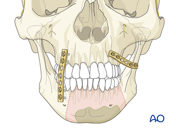Plate and scapular osteocutaneous free flap for Symphysis and skin