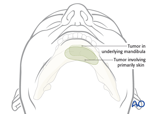 Plate and scapular osteocutaneous free flap for Symphysis and skin