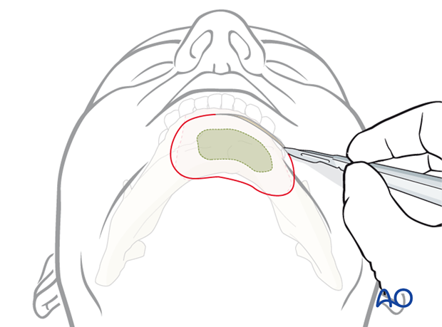 Plate and scapular osteocutaneous free flap for Symphysis and skin