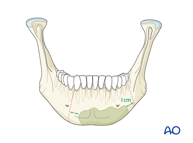 Plate and scapular osteocutaneous free flap for Symphysis and skin