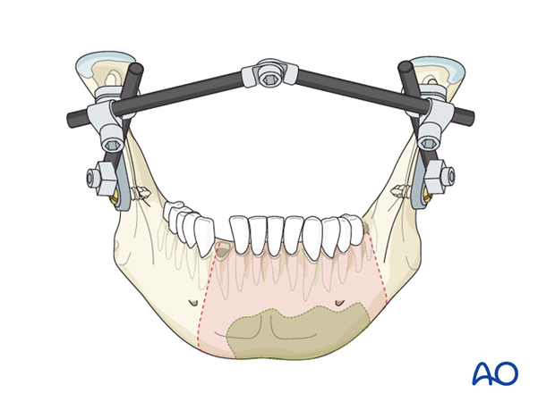 Plate and scapular osteocutaneous free flap for Symphysis and skin