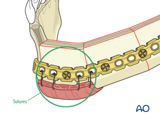 Plate and scapular osteocutaneous free flap for Symphysis and skin