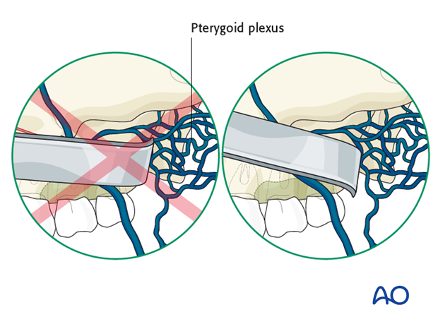 Temporalis muscle flap for Brown I, alveolus