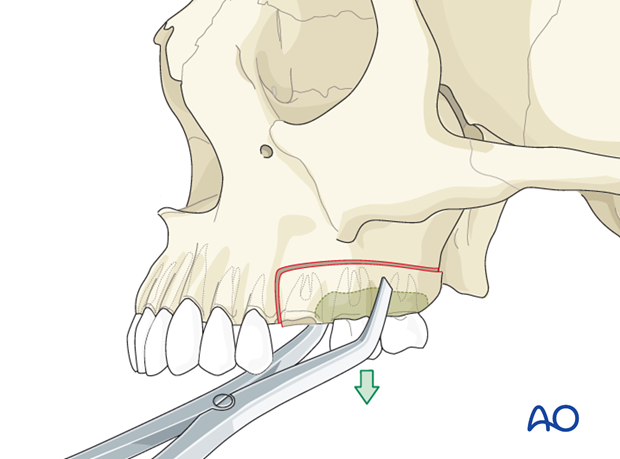 Temporalis muscle flap for Brown I, alveolus