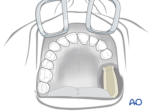 Temporalis muscle flap for Brown I, alveolus