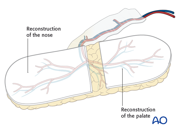 Rectus abdominis fasciocutaneous free flap for Brown III