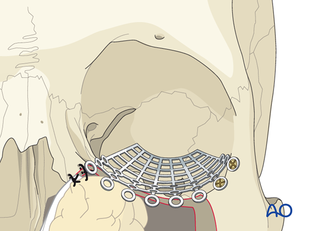 Rectus abdominis fasciocutaneous free flap for Brown III