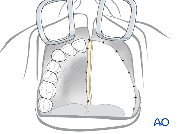 Rectus abdominis fasciocutaneous free flap for Brown III
