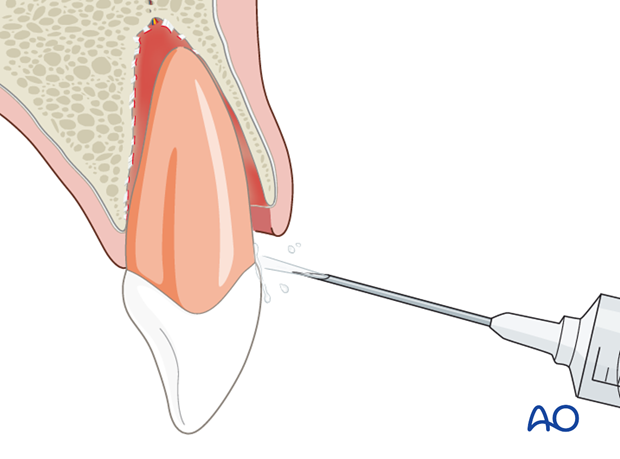 Repositioning and fixation for Tooth luxation with displacement - Extrusion