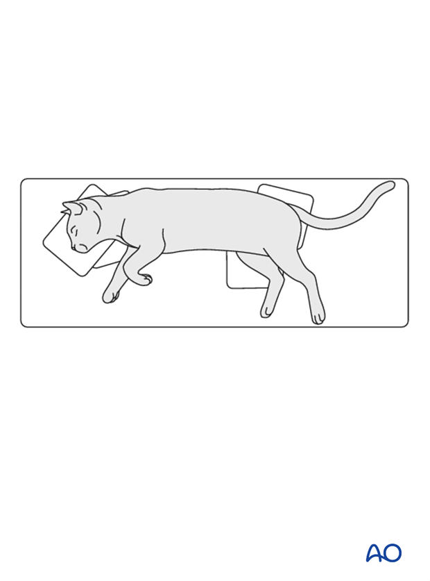 Tie-in technique for Complex fractures with non- reconstructible wedges ...