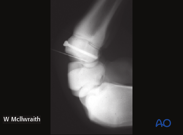 Arthroscopic screw fixation for 3rd carpal bone: Frontal slab fractures ...