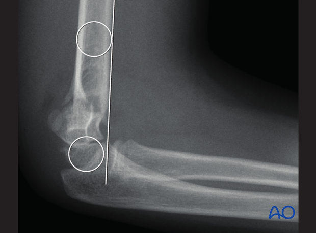 13-M/3.1 II Simple, incomplete, displaced