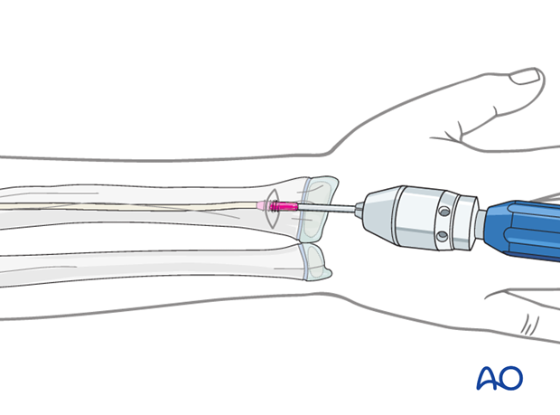 ESIN for 21r-E/1.1 - Radius, Salter-Harris I