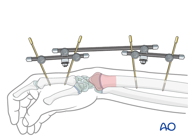 External fixation for 23r-E/2.1 Simple epiphysiolysis with metaphyseal ...
